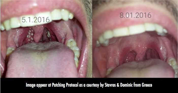 LifeWave Patches and Tonsils Infection - Patching Protocol